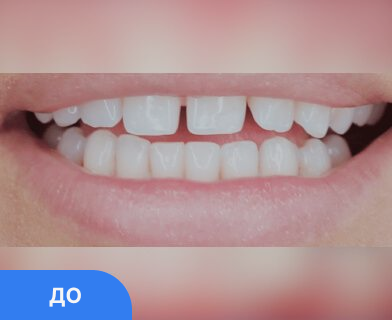 Виниры установка недорого - стоимость от 7500 руб. E-MAX - 25000 руб ...