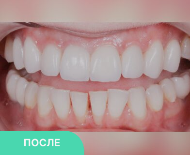 Виниры установка недорого - стоимость от 7500 руб. E-MAX - 25000 руб ...