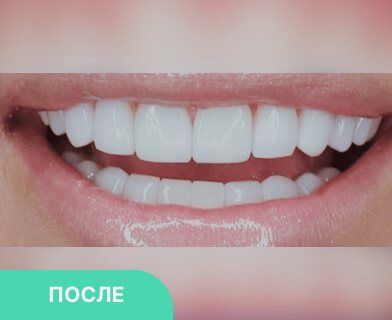 Виниры установка недорого - стоимость от 7500 руб. E-MAX - 25000 руб ...